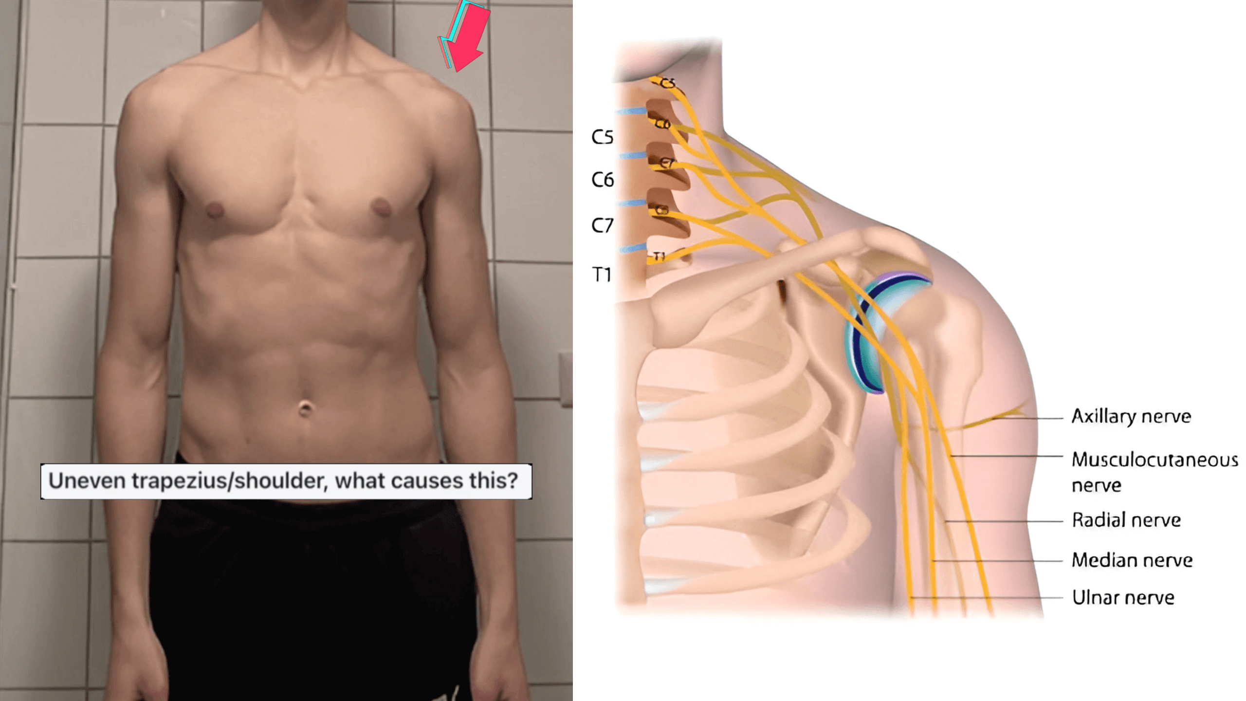 Shoulder Imbalance FIXED in 30 Seconds – Posturepro EU